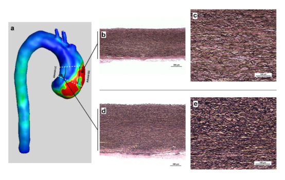 4D flow MRI在大血管的应用研究 - 杭州晟视科技有限公司
