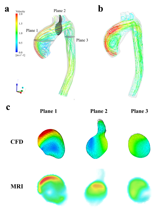 4D flow MRI在大血管的应用研究 - 杭州晟视科技有限公司